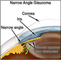 Coastal Eye Care: Technology: LPI – Coastal Eye Care